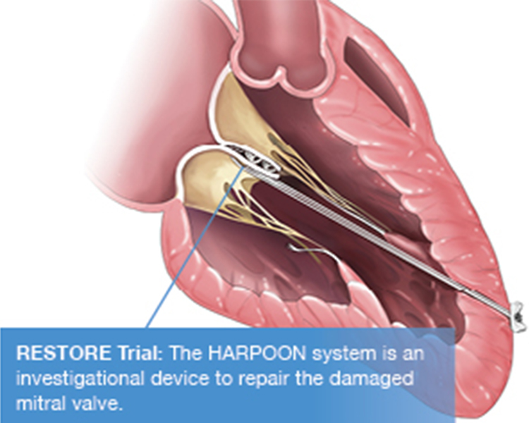 Hoag Offers Unique, Tailored Approach for Mitral Valve Care | Hoag