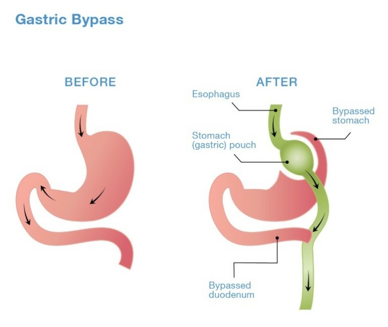 Roux Y Gastric Bypass Anatomy A Anatomical Components Of Roux En Y